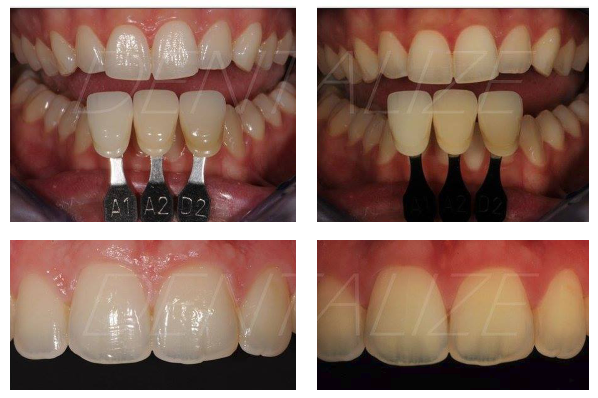 Color matching in prosthodontics - Dentalize Polarizing Filters