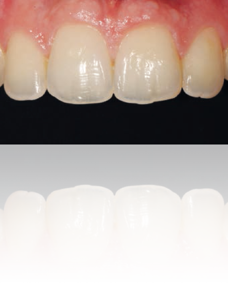 Dentalize | Polarizing filters for macro photography and odonthology